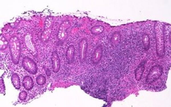 The Role of Genetics and Immune Dysregulation in VEO-IBD - CHOP OPEN