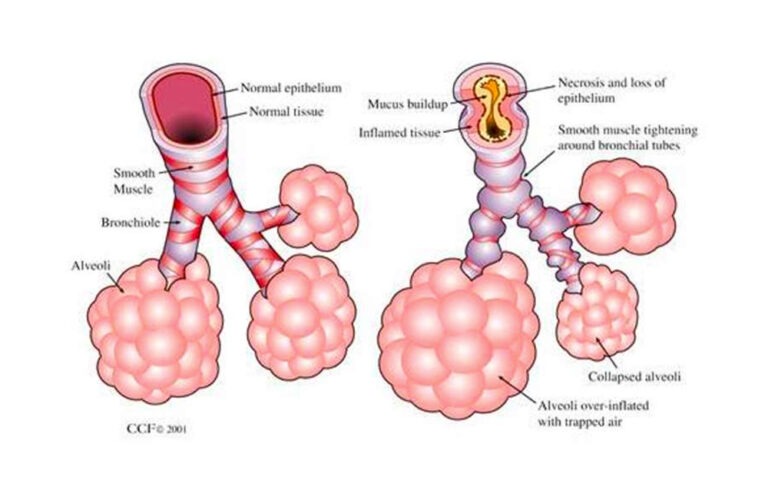 Bronchiolitis: Diagnosis and Management - CHOP OPEN