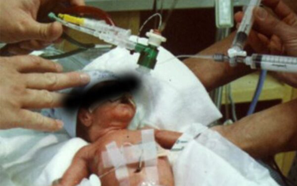Neonatal Respiratory Distress Syndrome - CHOP OPEN