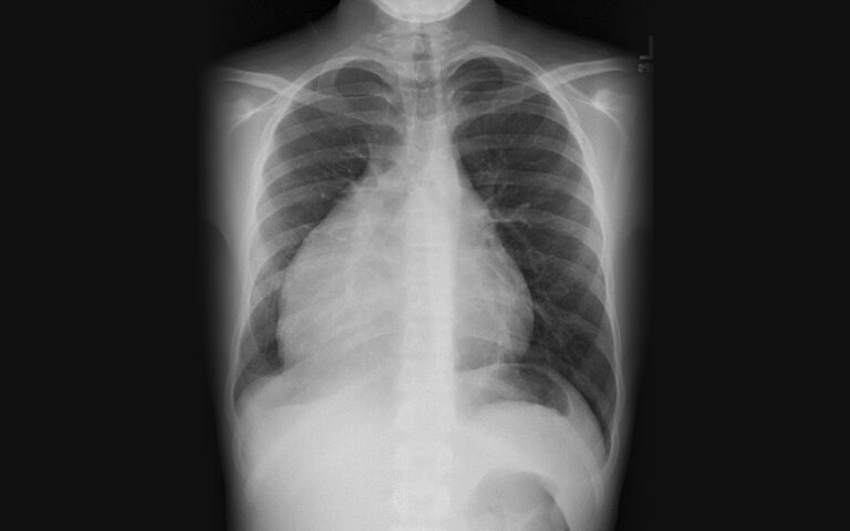 Pediatric Chest Masses - CHOP OPEN