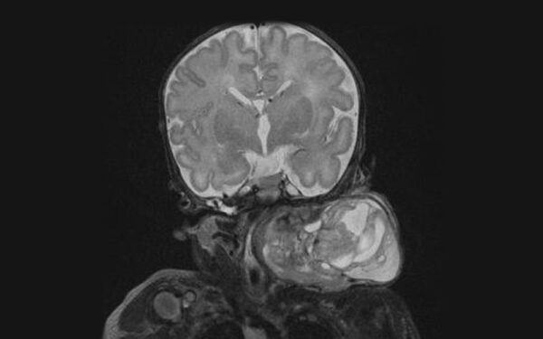 Pediatric Orbit, Face & Neck Tumors - CHOP OPEN