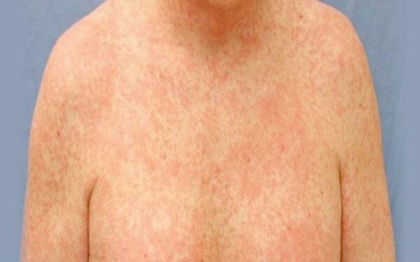 Fever and Rash Syndromes - CHOP OPEN