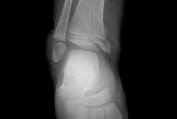 Pediatric Fracture Care: Pearls and Pitfalls - CHOP OPEN