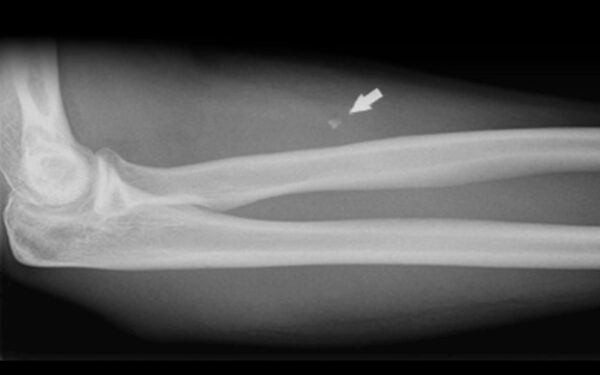 Common ED Procedures - CHOP OPEN