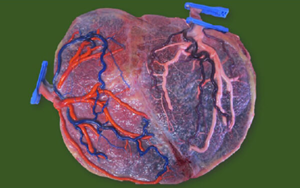 Fetal Fireside: Prenatal and Postnatal Management of Twin Anemia ...