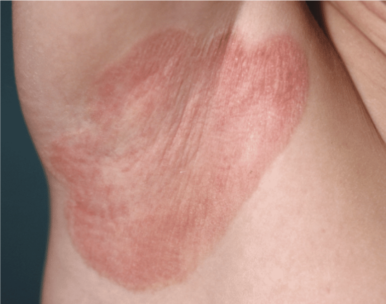 Dermatology Pearls for Primary Care - Module 1 - CHOP OPEN
