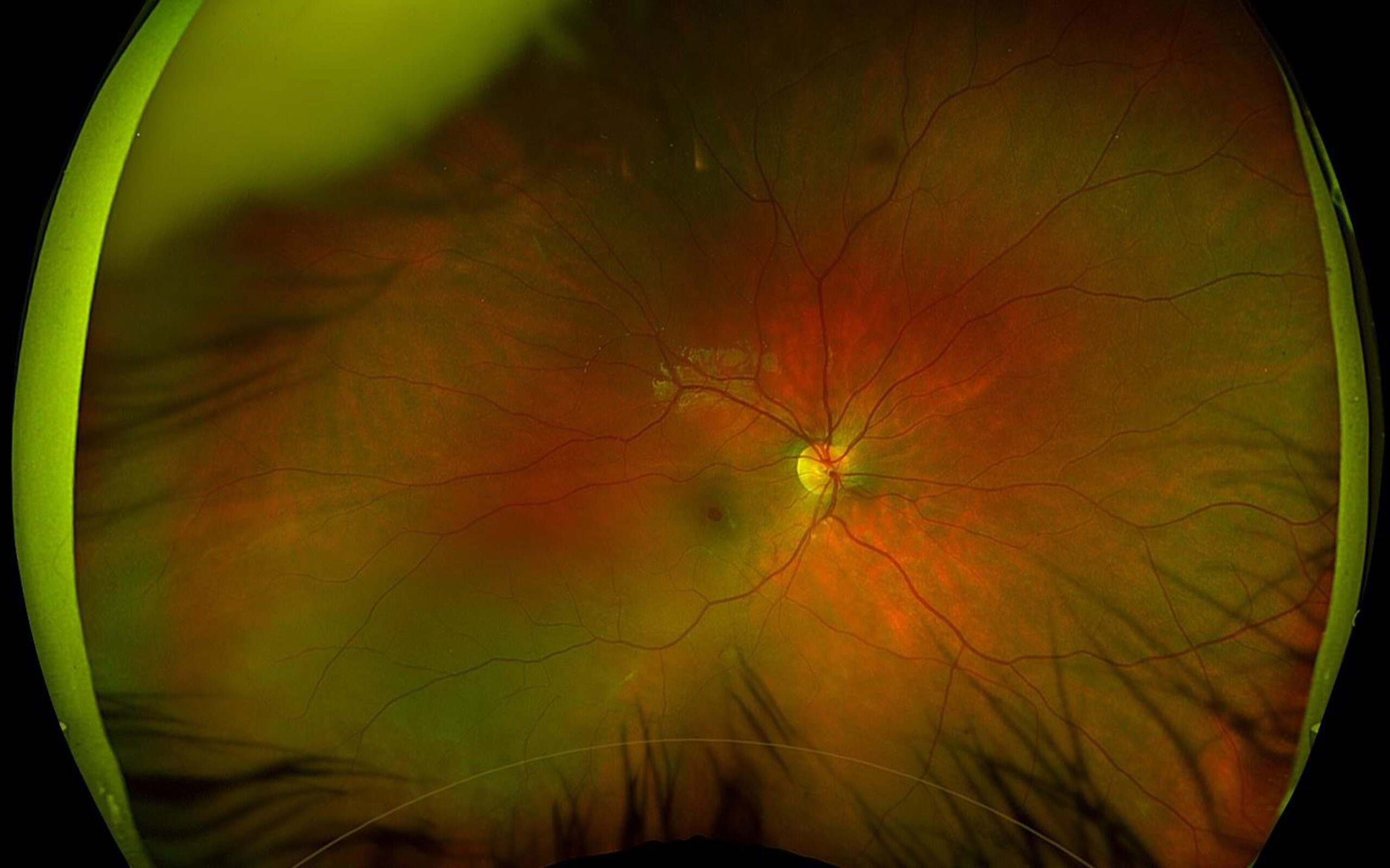 Pediatric Retinal Detachment - CHOP OPEN