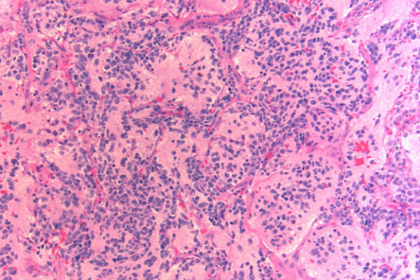 Therapy for Children with High-Risk and Relapsed Neuroblastoma - CHOP ...