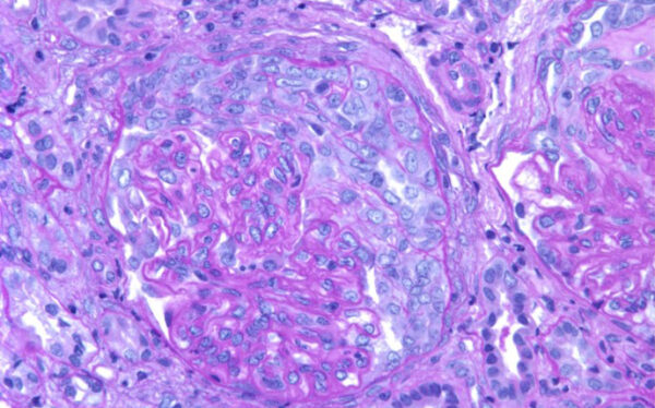 Acute Glomerulonephritis in Children - CHOP OPEN