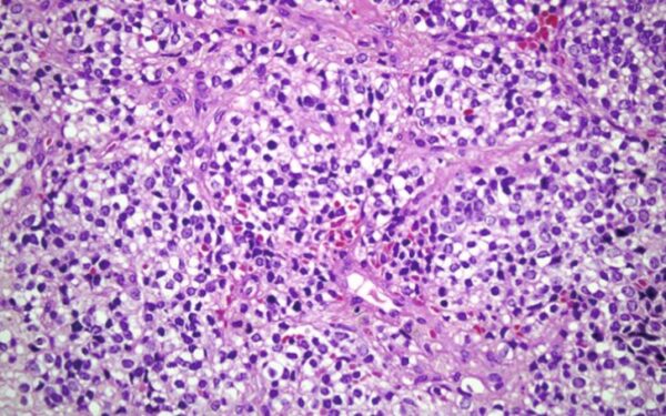 Pediatric Bone Sarcomas – CHOP Cancer Center International Seminar ...